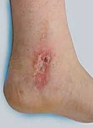 Venous Insufficiency Ulcer
